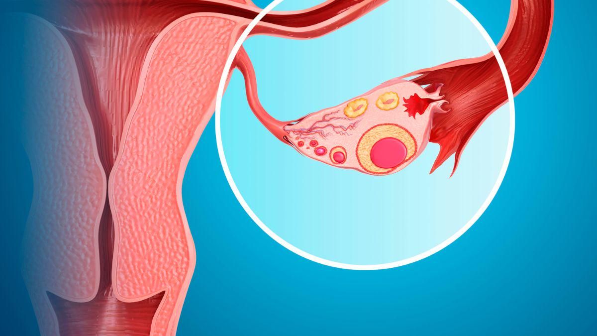 Ovarium pada Wanita, Fungsi, Struktur dan Gangguan yang Bisa Terjadi - KlikDokter